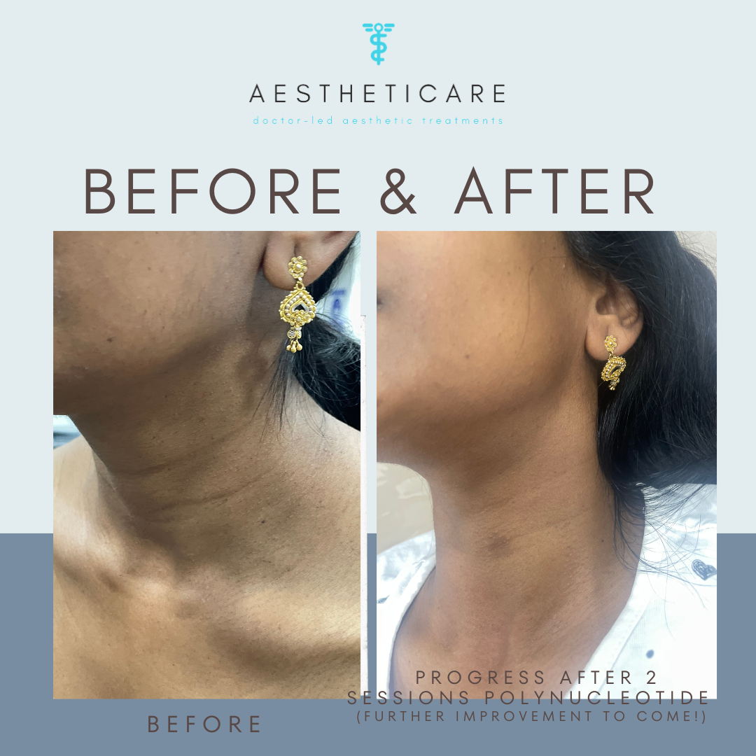 Polynucleotide Treatment London | Skin Rejuvenation Moorgate